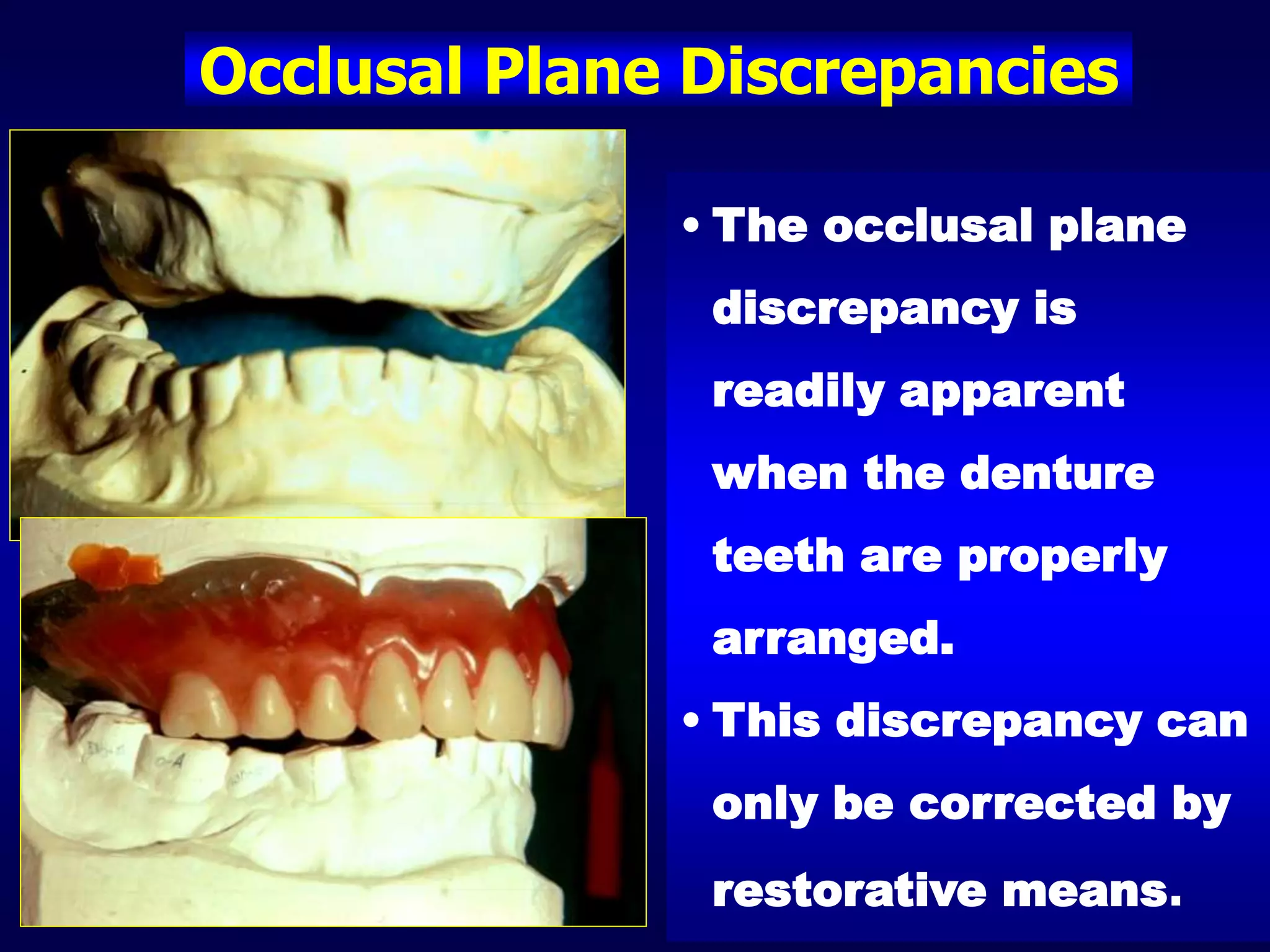 3 a. management of maxillary and mandibular single complete dentures | PPT
