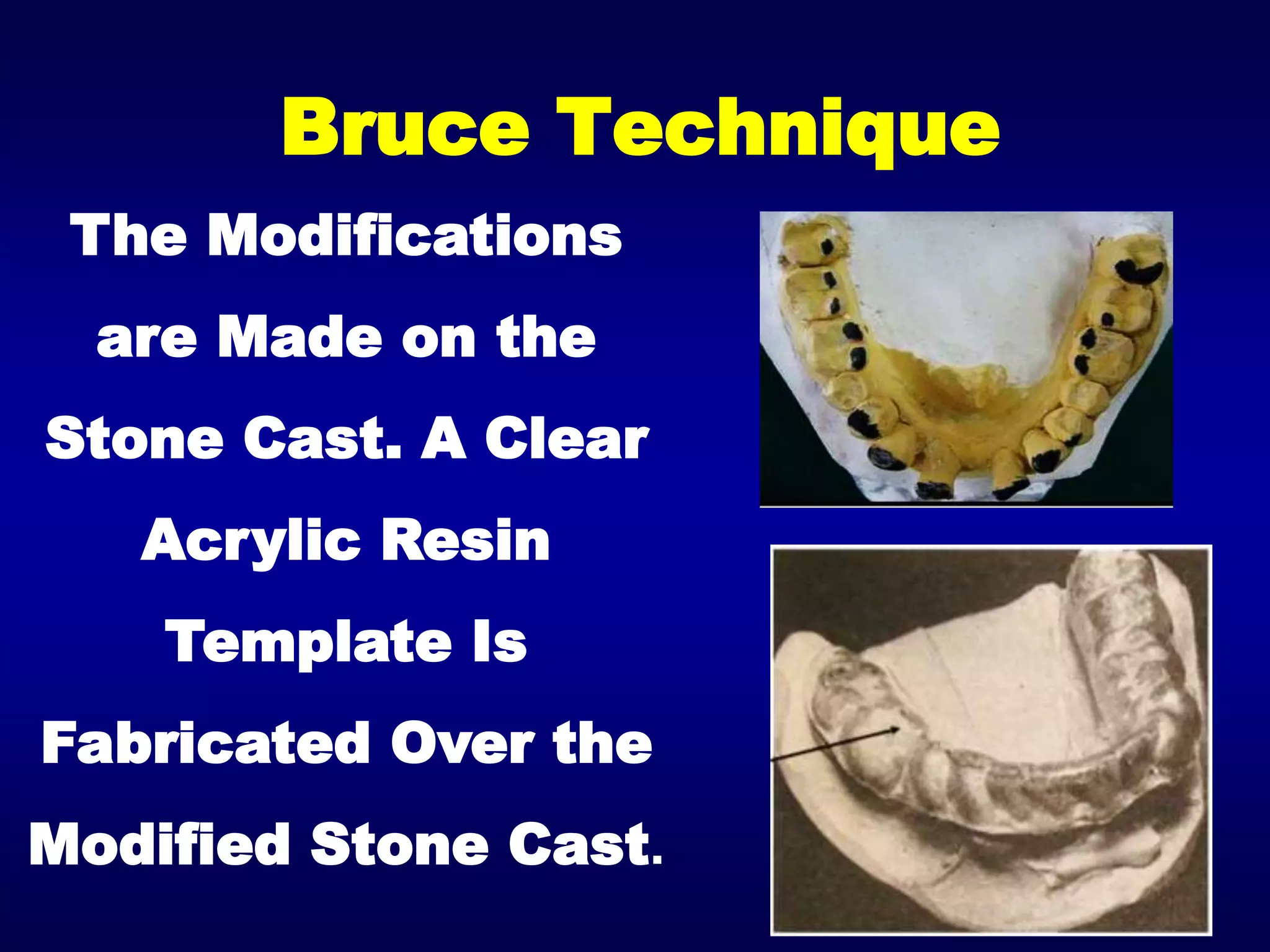 3 a. management of maxillary and mandibular single complete dentures | PPT