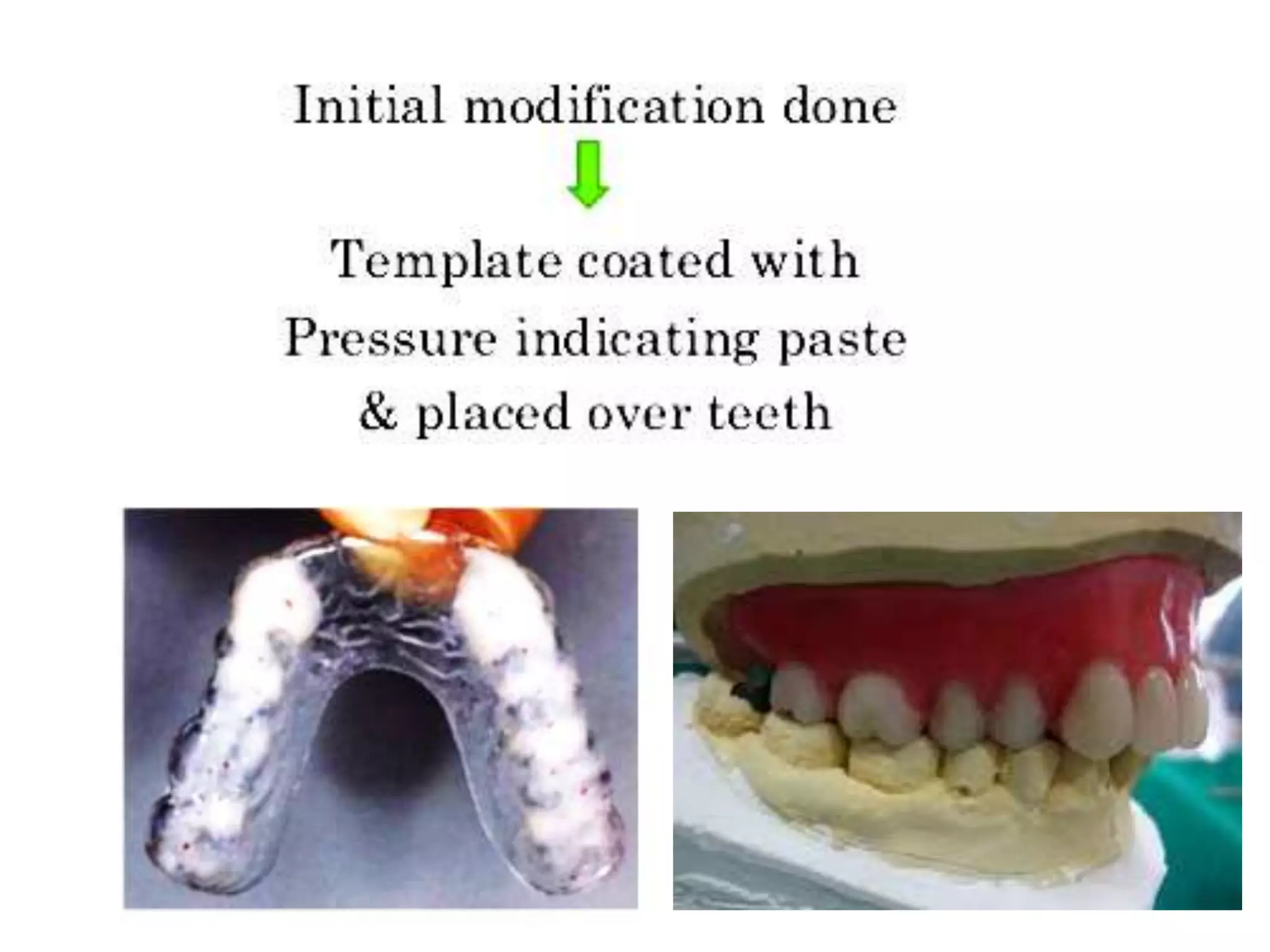3 a. management of maxillary and mandibular single complete dentures | PPT