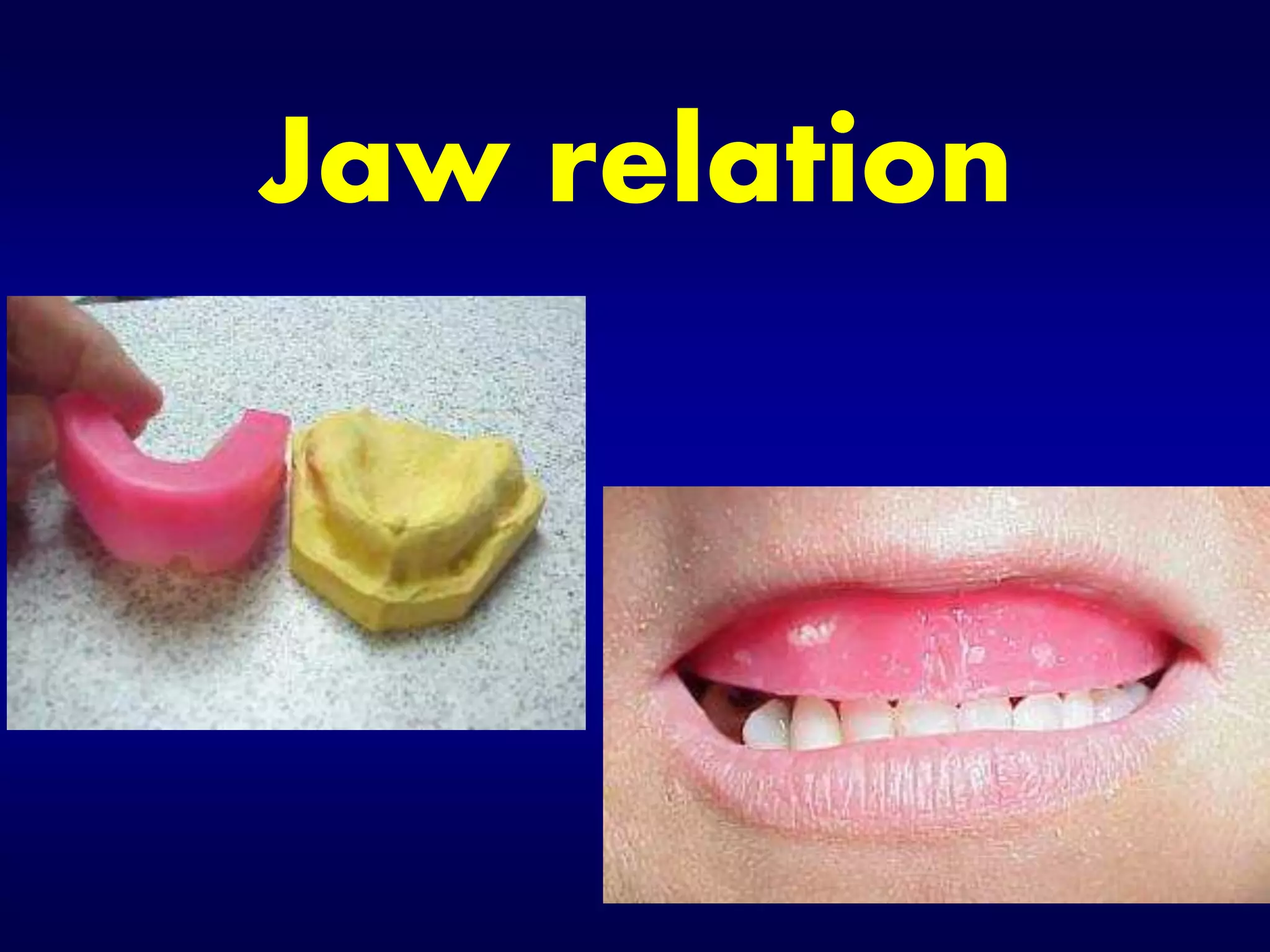 3 a. management of maxillary and mandibular single complete dentures | PPT