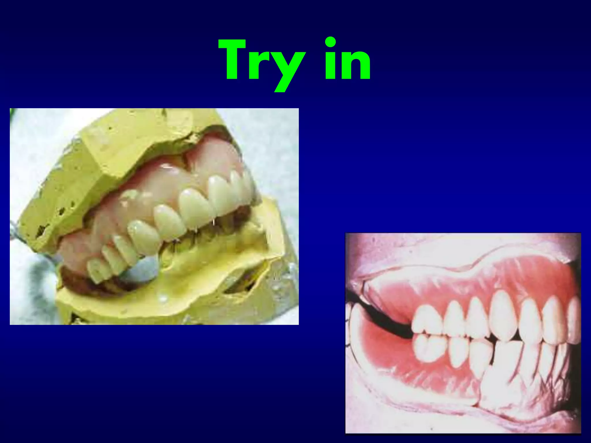 3 a. management of maxillary and mandibular single complete dentures | PPT