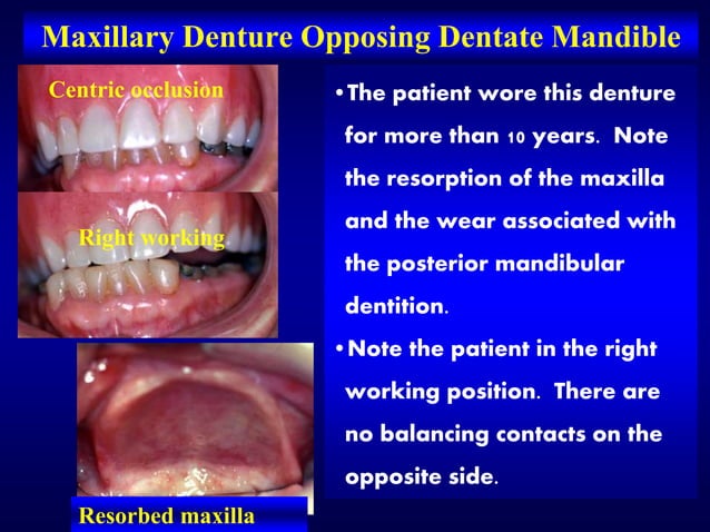 3 a. management of maxillary and mandibular single complete dentures | PPT