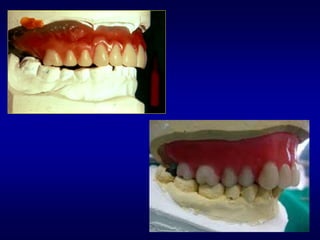 3 a. management of maxillary and mandibular single complete dentures | PPT