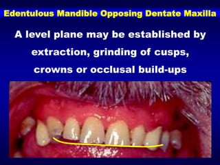 3 a. management of maxillary and mandibular single complete dentures | PPT