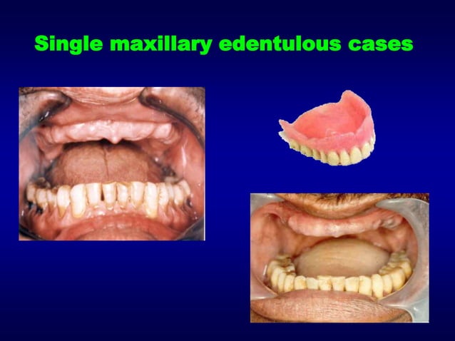 3 a. management of maxillary and mandibular single complete dentures | PPT