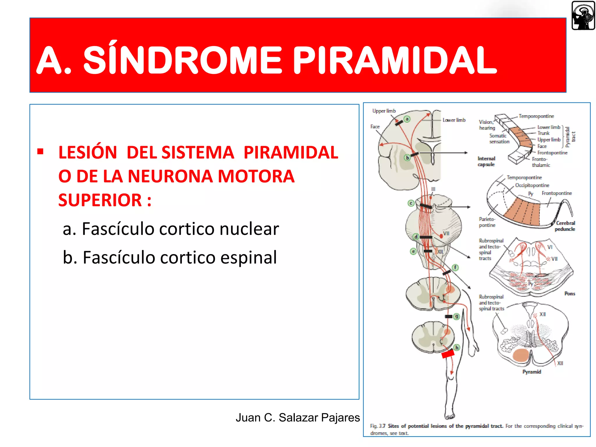 síndromes neurológicos 1 síndrome piramidal
