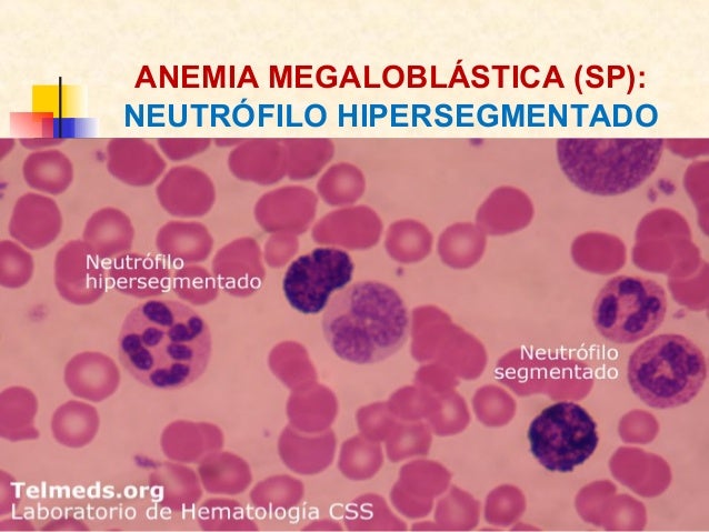 3 Anemias Carenciais Megaloblásticas