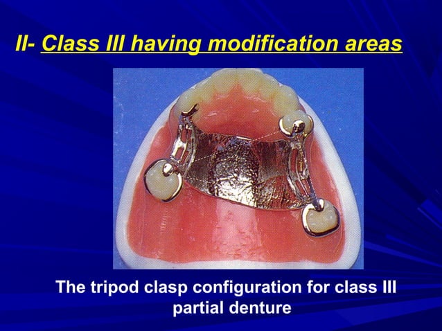3 basic principles for designing class ii and iii and iv | PPT