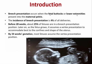 3- breech Presentation obstetrics and gynacology.pdf
