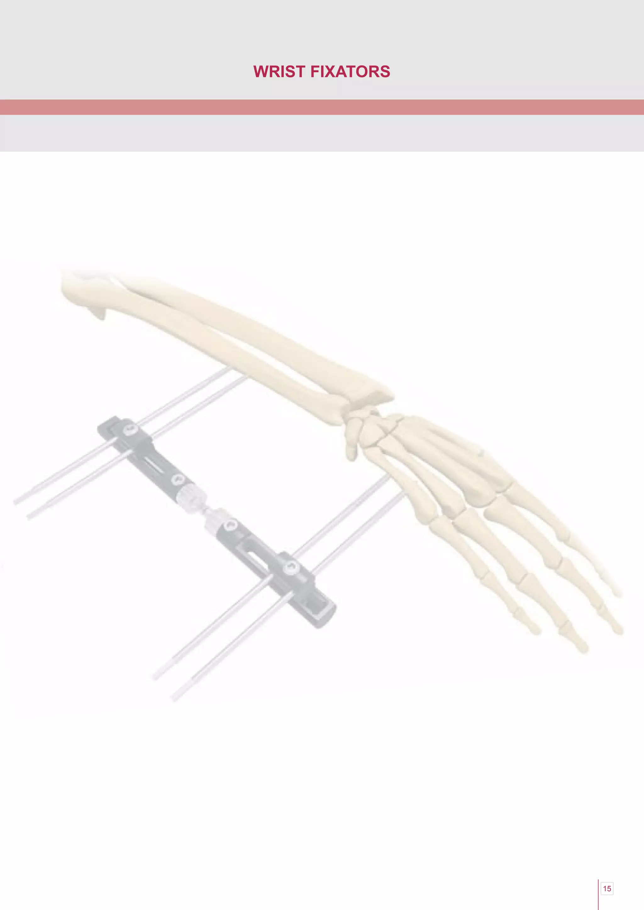 3 brochure external-fixators | PDF | Bone and Joint Conditions ...