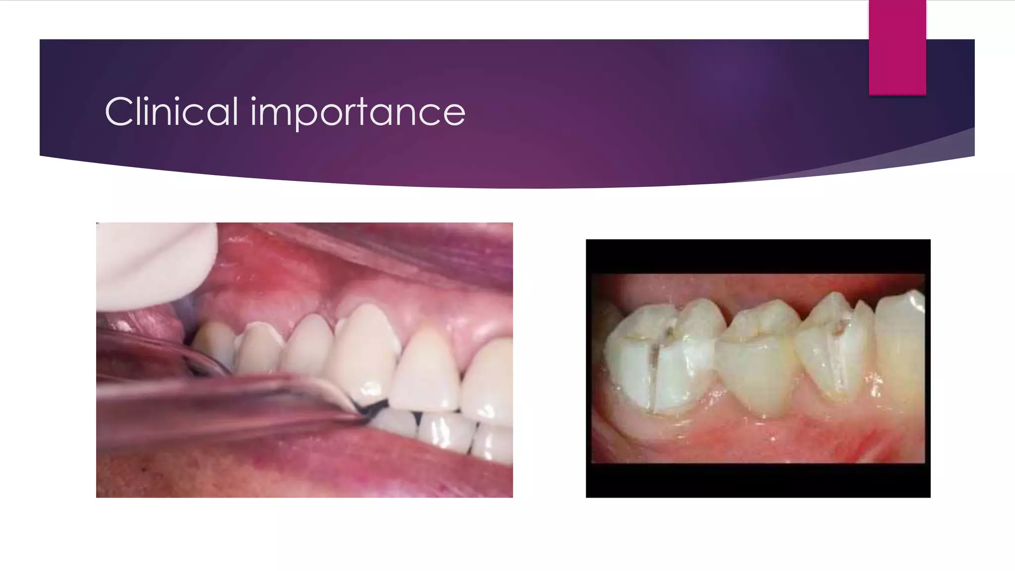 cementation in Fixed prosthodontics | PPTX