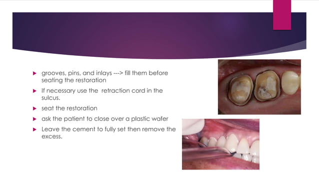 cementation in Fixed prosthodontics | PPTX