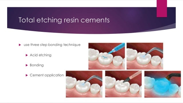cementation in Fixed prosthodontics