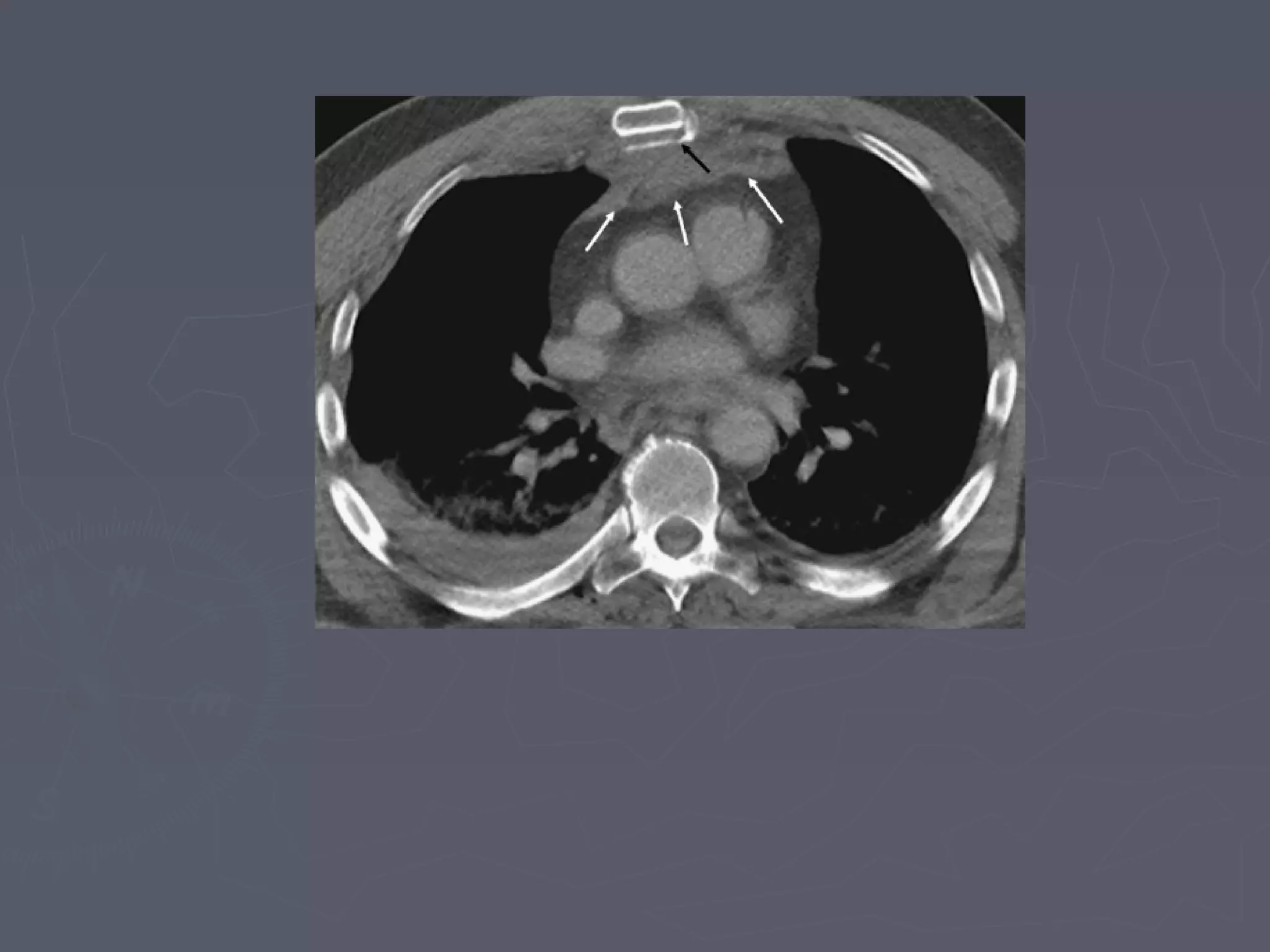 3- Chest emergency-trauma | PPT