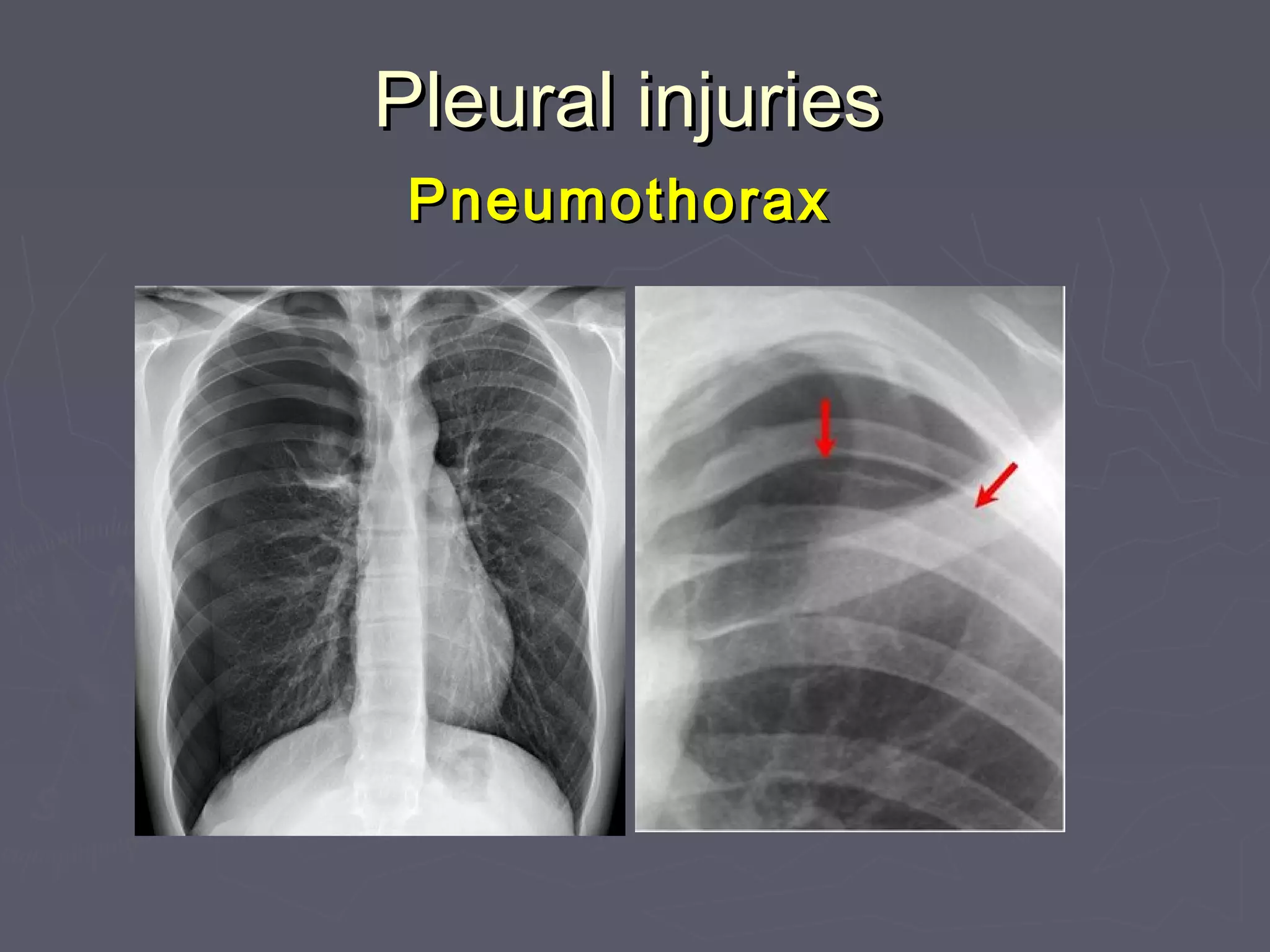 3- Chest emergency-trauma | PPT