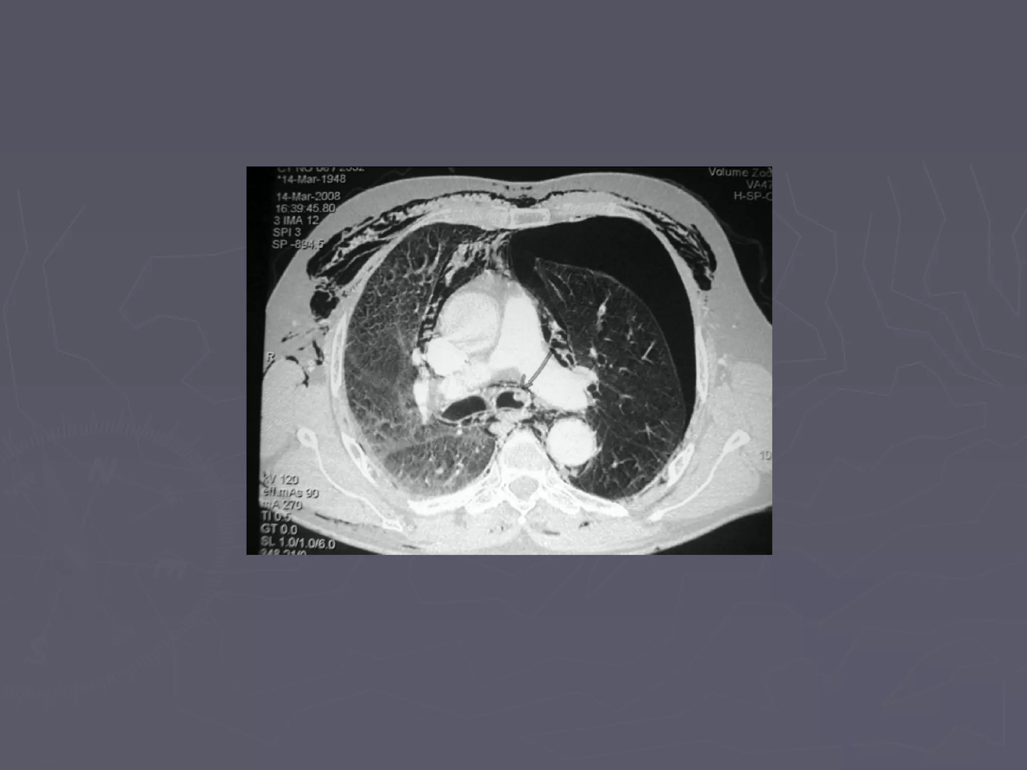3- Chest emergency-trauma | PPT