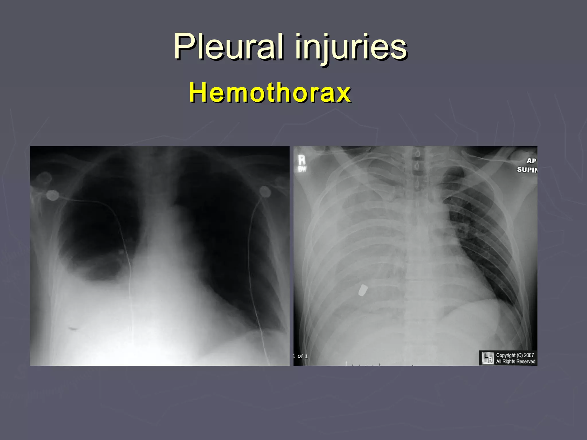 3- Chest emergency-trauma | PPT