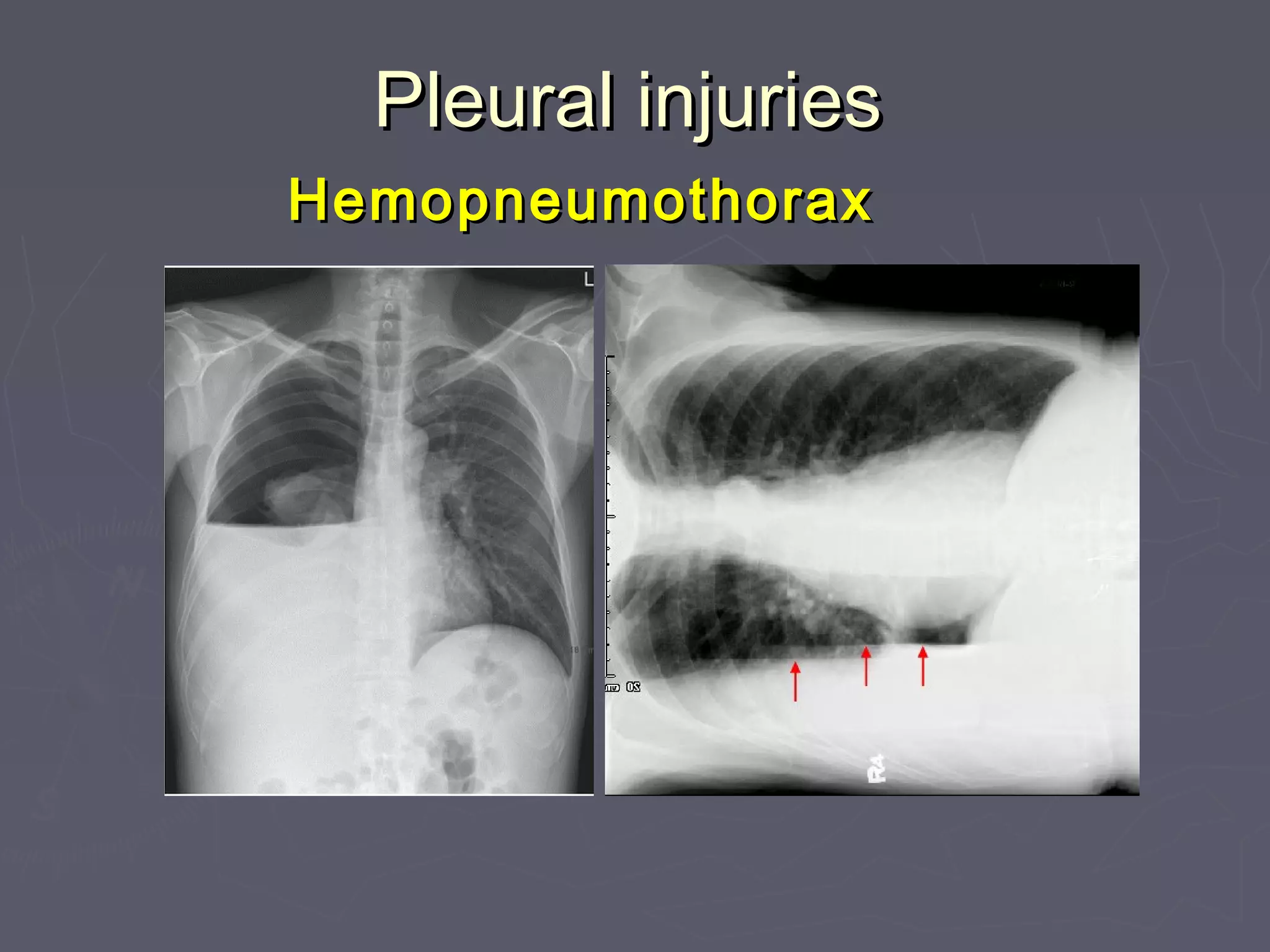 3- Chest emergency-trauma | PPT