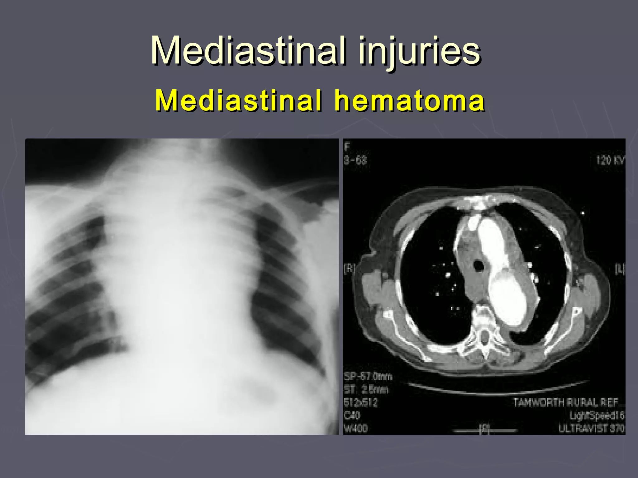 3- Chest emergency-trauma | PPT