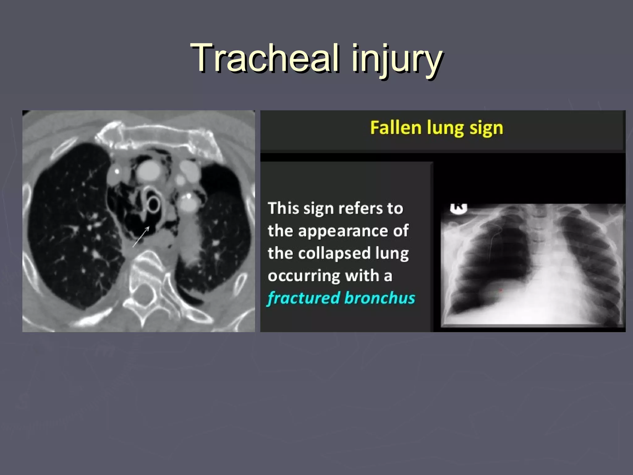 3- Chest emergency-trauma | PPT