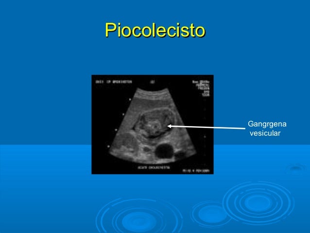 3 colecistitis aguda y cronica