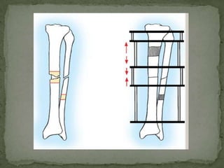 Delayed Union and non union fractures | PPTX