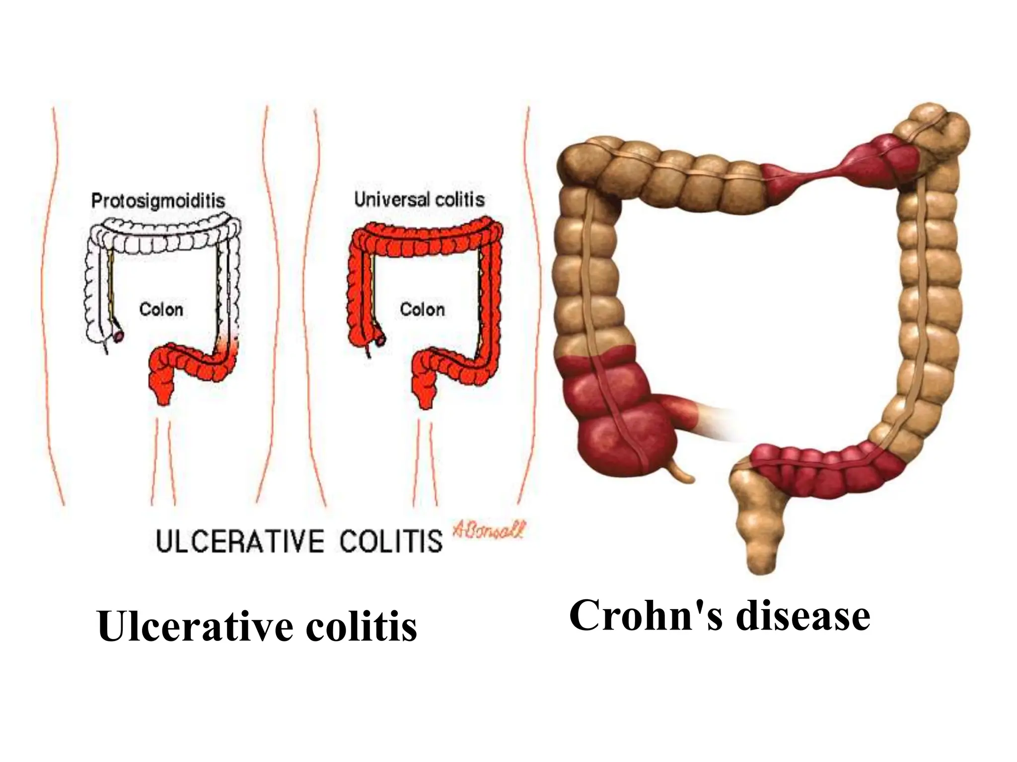 3- Drugs used in inflammatory bowel disease.ppt