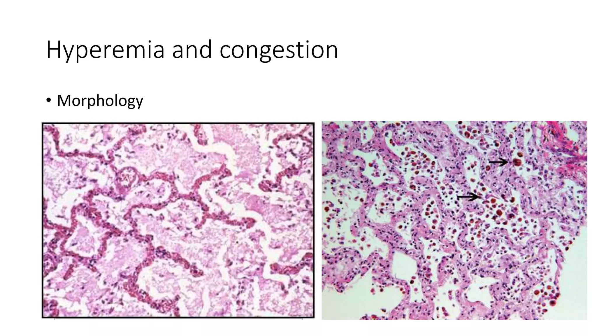 Hemodynamic disorders - Edema, Hyperemia, Hemorrahge by DR. ROOPAM JAIN ...