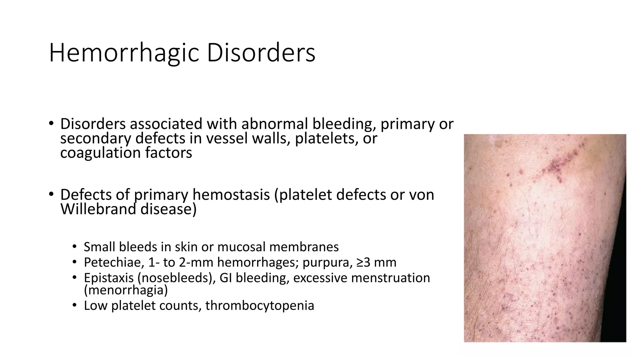 Hemodynamic disorders - Edema, Hyperemia, Hemorrahge by DR. ROOPAM JAIN ...