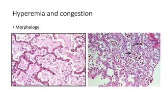 Hemodynamic disorders - Edema, Hyperemia, Hemorrahge by DR. ROOPAM JAIN ...