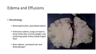 Hemodynamic disorders - Edema, Hyperemia, Hemorrahge by DR. ROOPAM JAIN ...