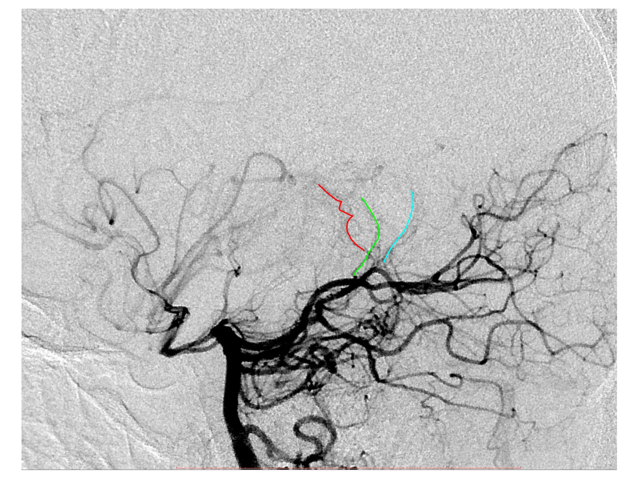 3-eke - angiographic anatomy.ppt MD STUDENT | PPT
