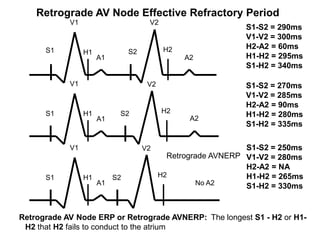 Electrophysiologic Study | PDF