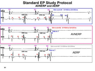 Electrophysiologic Study | PDF