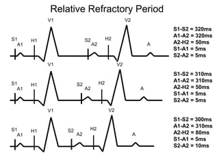Absolute Refractory Period Ecg