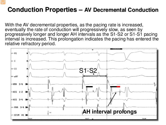 Electrophysiologic Study