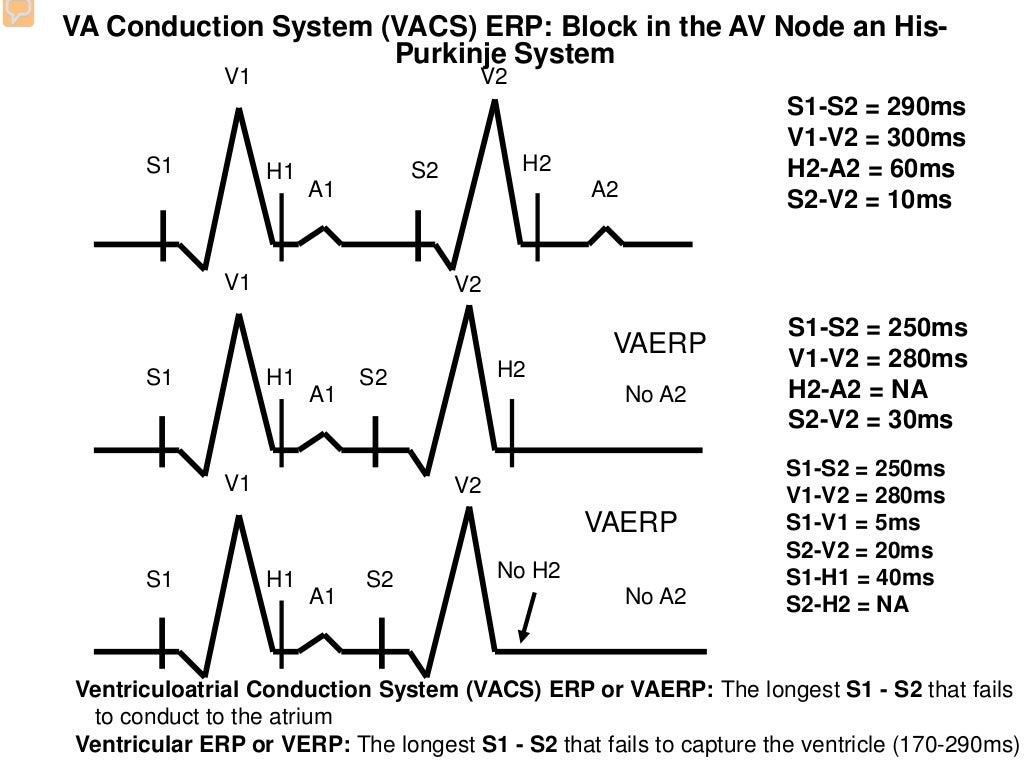 Electrophysiologic Study