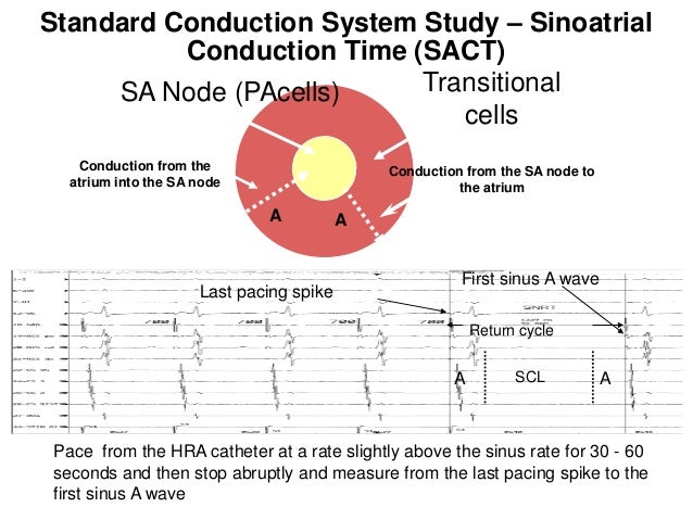 Electrophysiologic Study