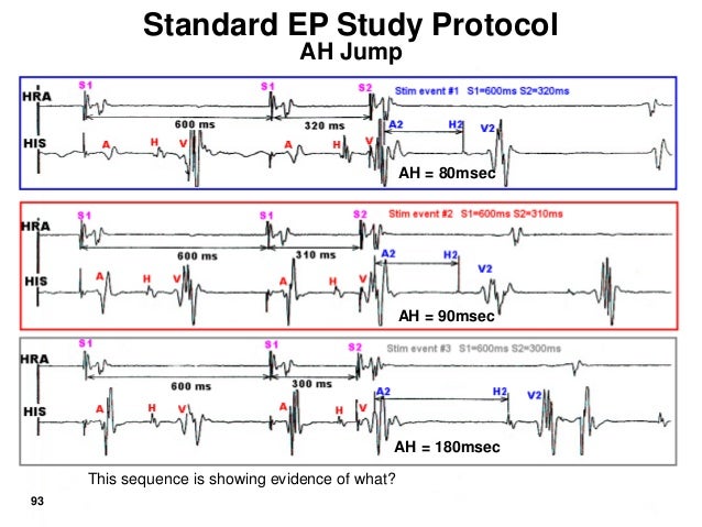 Electrophysiologic Study