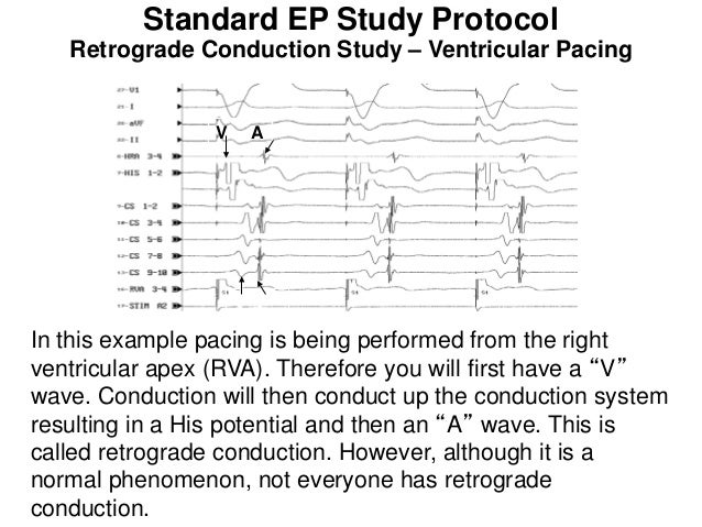 Electrophysiologic Study