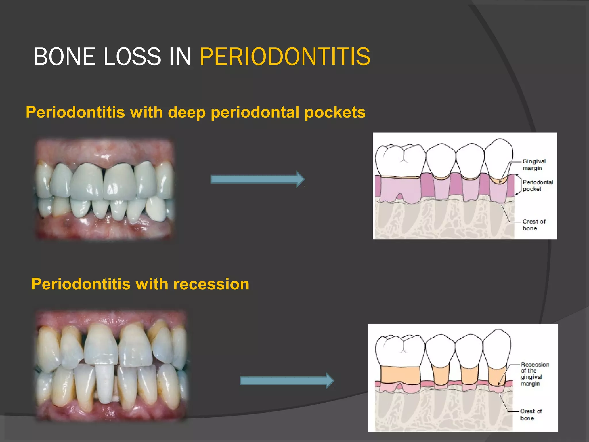 Periodontal examination and diagnosis | PPT