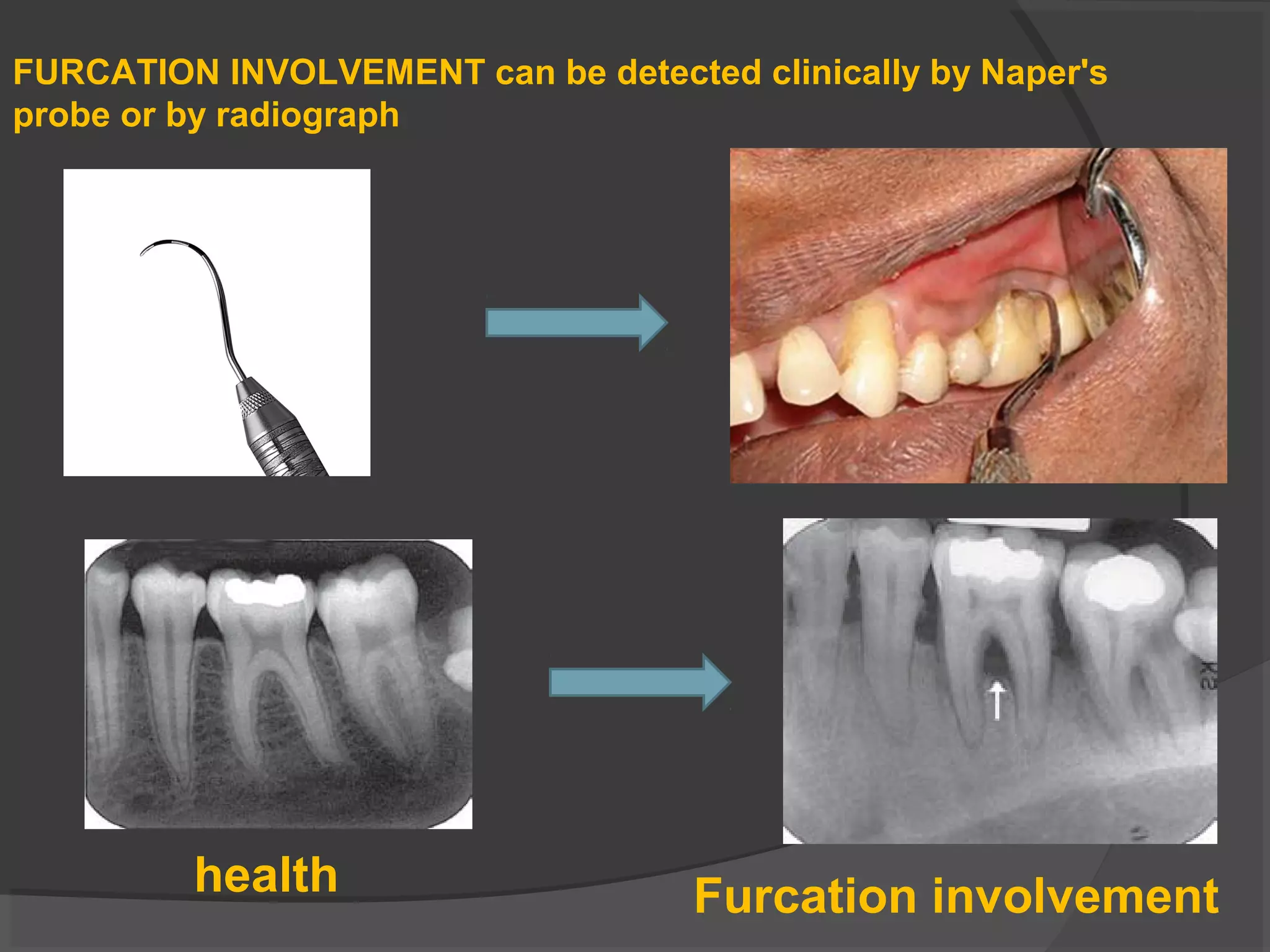 Periodontal examination and diagnosis | PPT