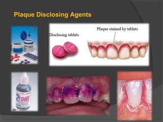 Periodontal examination and diagnosis | PPT