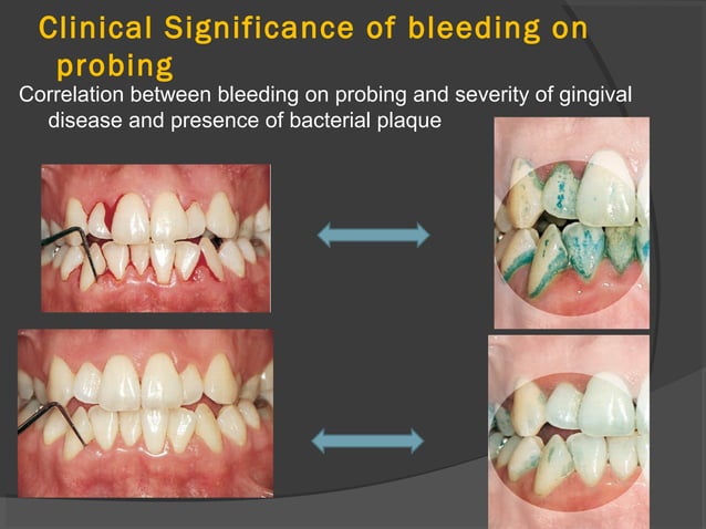 Periodontal examination and diagnosis | PPT