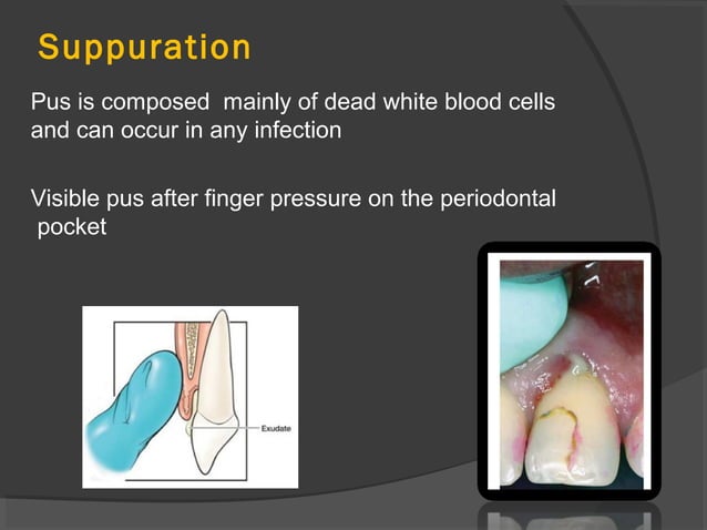 Periodontal examination and diagnosis | PPT