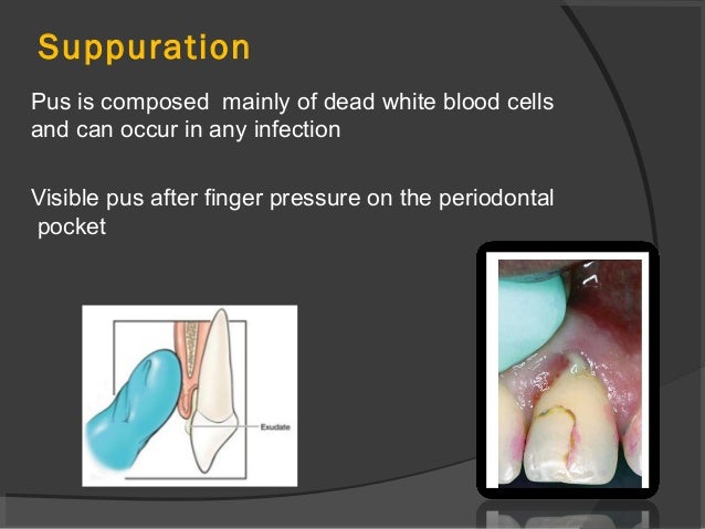 Periodontal examination and diagnosis