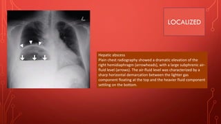 ABDOMINAL XRAYS REVIEW- EXTRALUMINAL GASES. | PDF