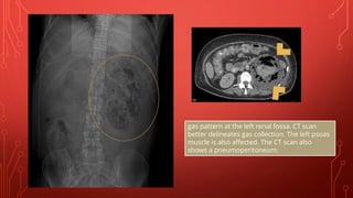 ABDOMINAL XRAYS REVIEW- EXTRALUMINAL GASES. | PDF