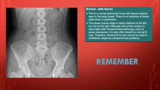 ABDOMINAL XRAYS REVIEW- EXTRALUMINAL GASES. | PDF