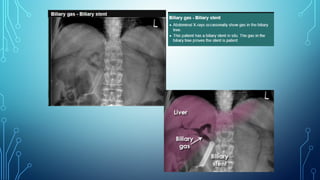 ABDOMINAL XRAYS REVIEW- EXTRALUMINAL GASES. | PDF